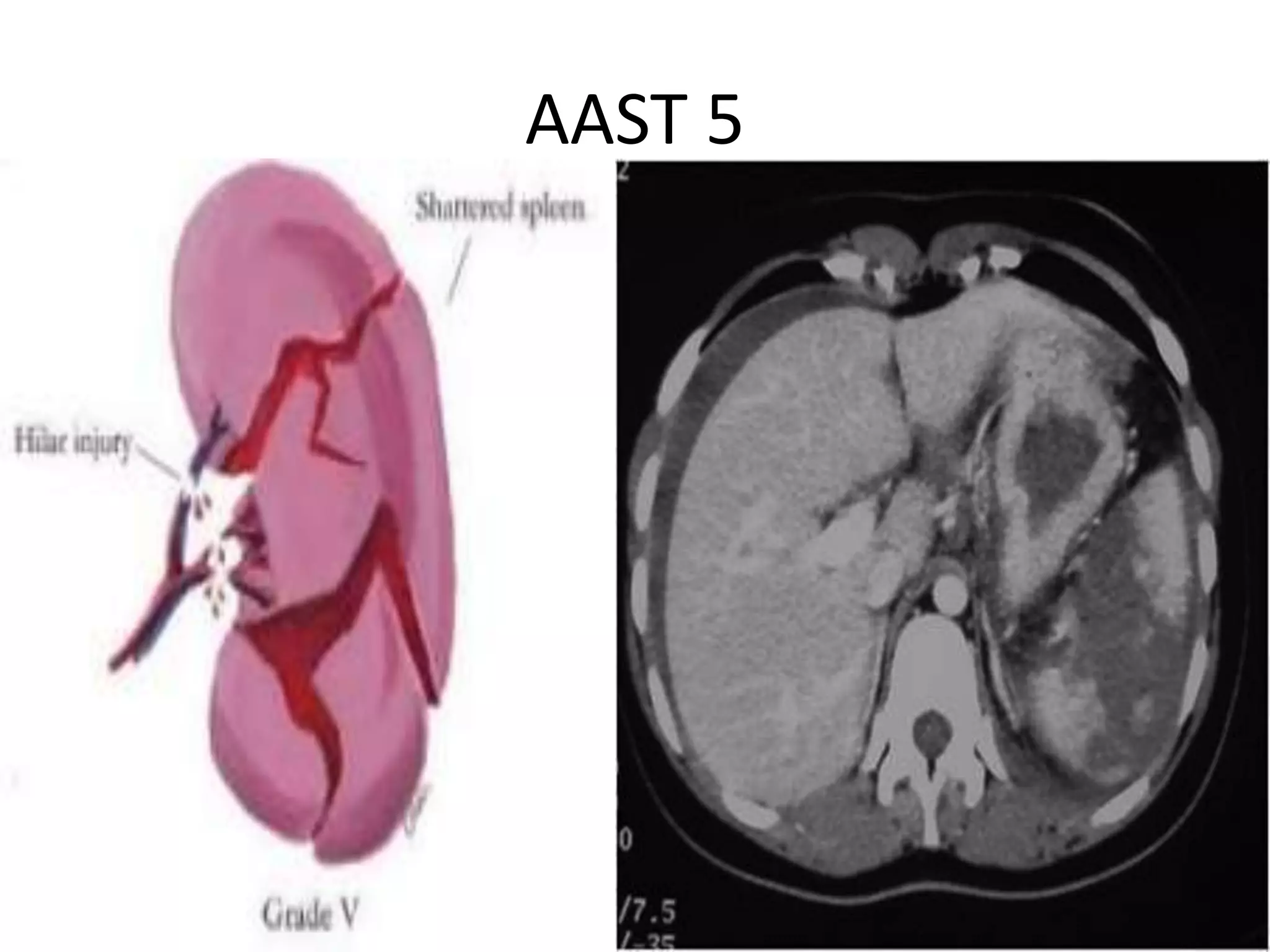Splenic injuries ppt by manjusb | PPTX