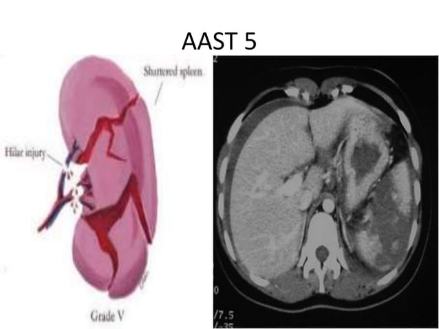 Splenic injuries ppt by manjusb | PPTX