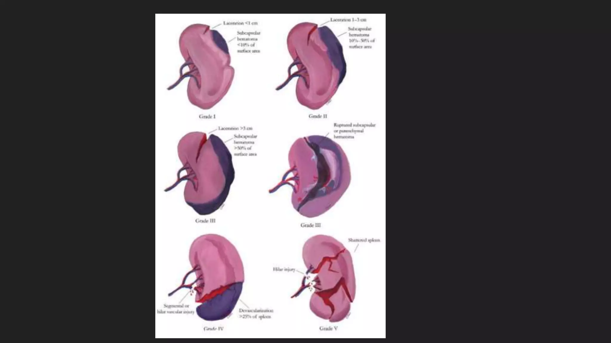 Traumatic Splenic injury - A brief literature review | PPTX