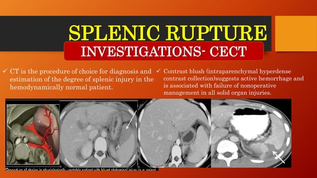 SPLENIC INJURY.pptx | Death, Injury, or Military Conflict | Sensitive ...