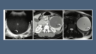 splenic lesions and findings of ct and usg | PPTX