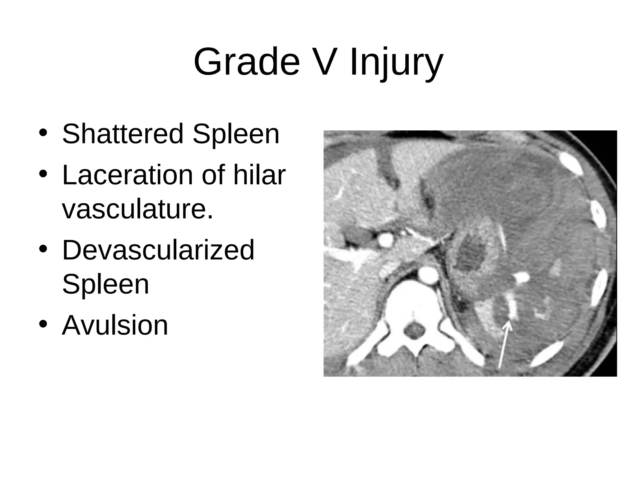 Splenic trauma - Causes, Complications, Management | PDF