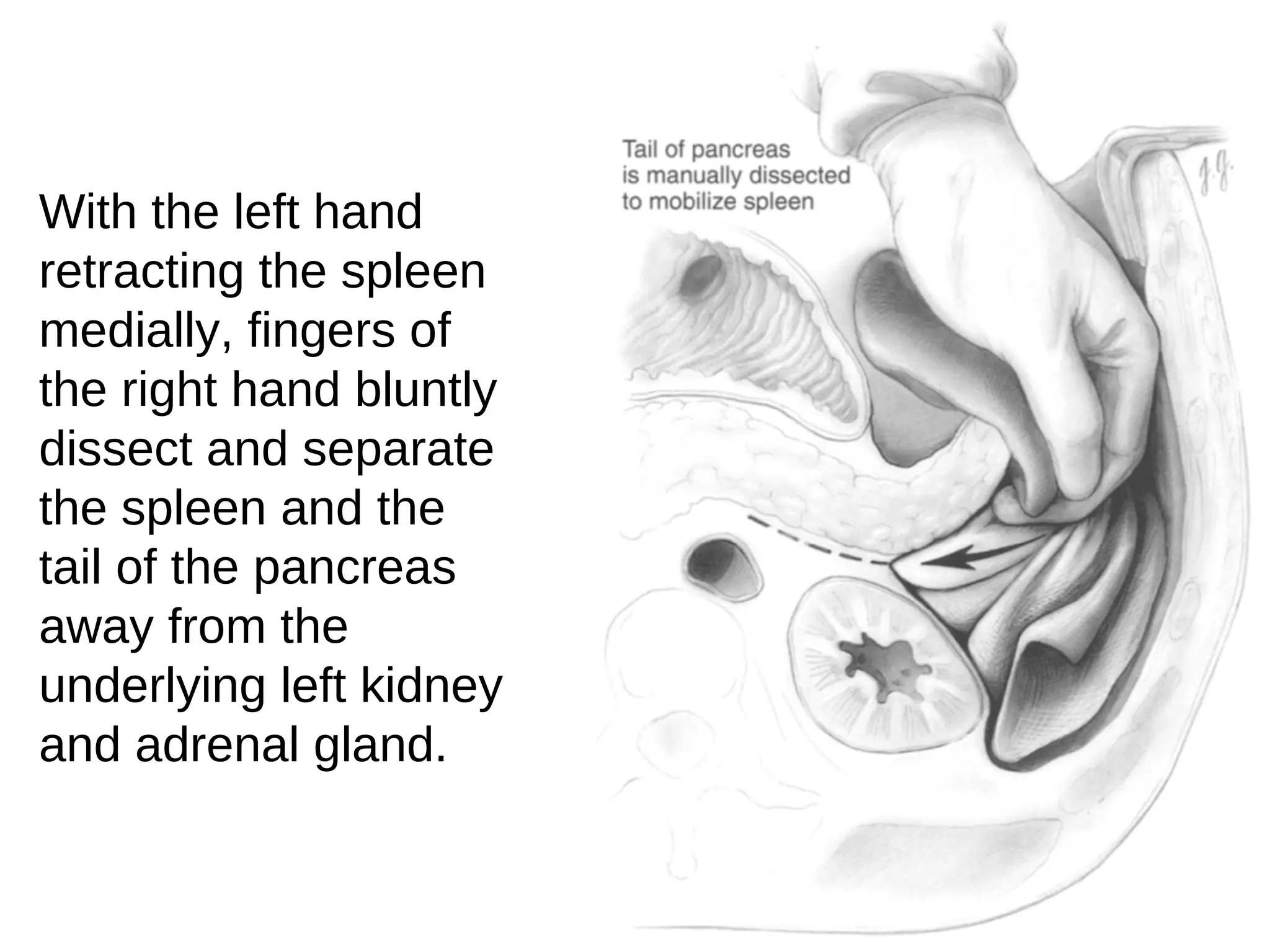 Splenic trauma - Causes, Complications, Management | PDF | First Aid ...