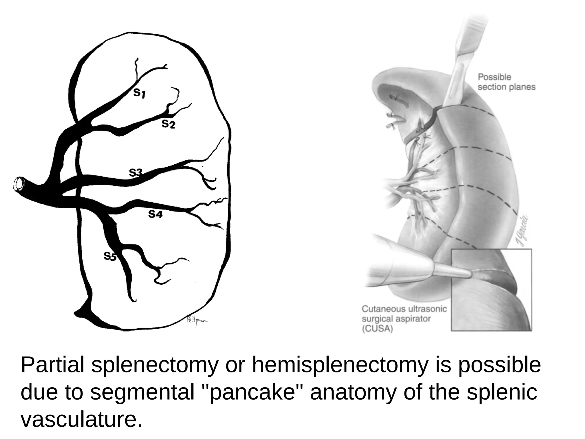 Splenic trauma - Causes, Complications, Management | PDF