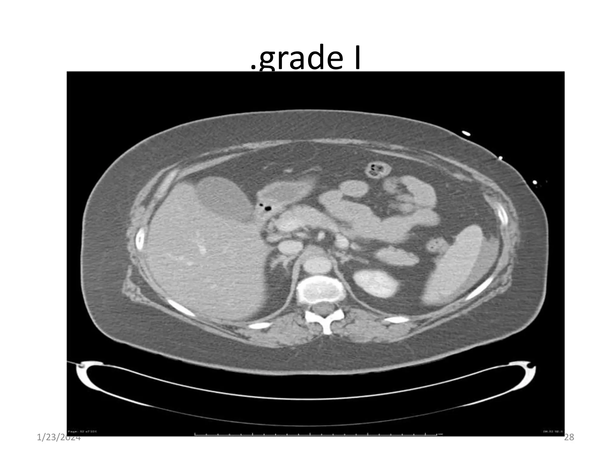 splenic trauma imaging modalities. .pptx
