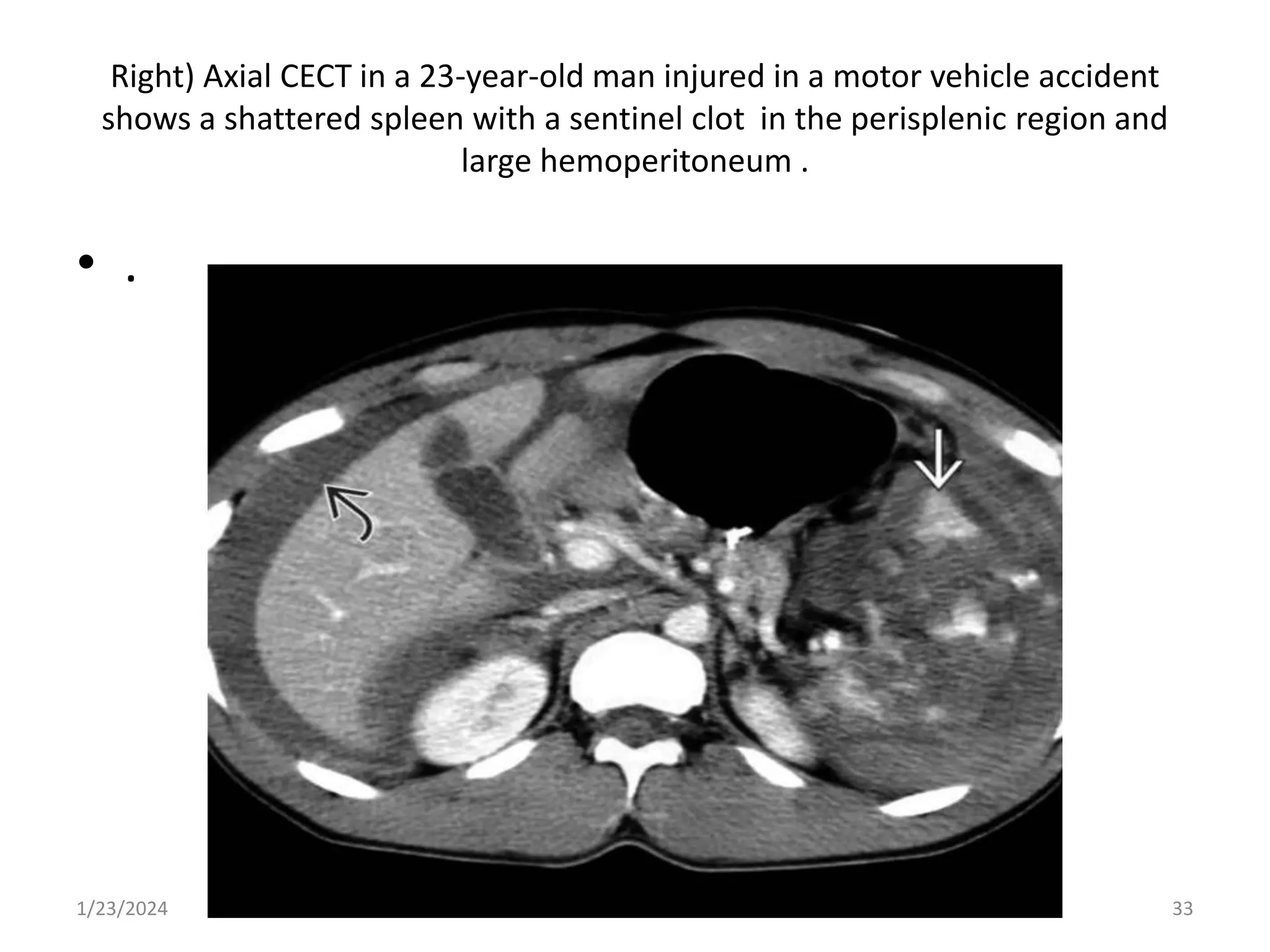 splenic trauma imaging modalities. .pptx