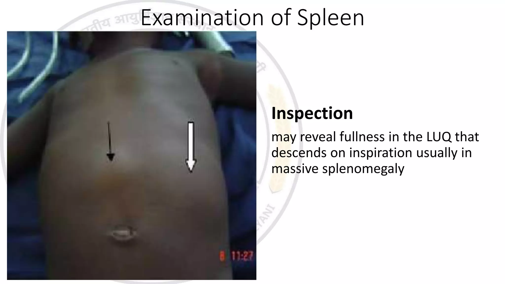 approach to splenomegaly | PPTX