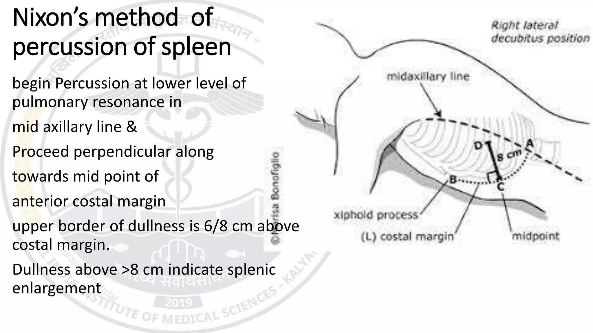 approach to splenomegaly | PPTX