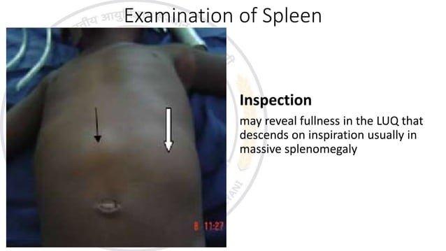 approach to splenomegaly | PPT