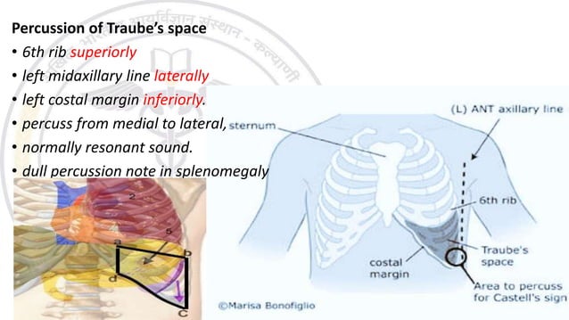 approach to splenomegaly | PPTX
