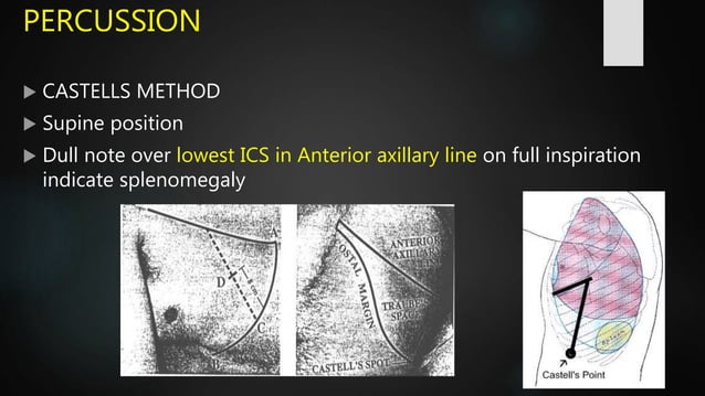 Splenomegaly : causes , clinical approach and examination | PPT