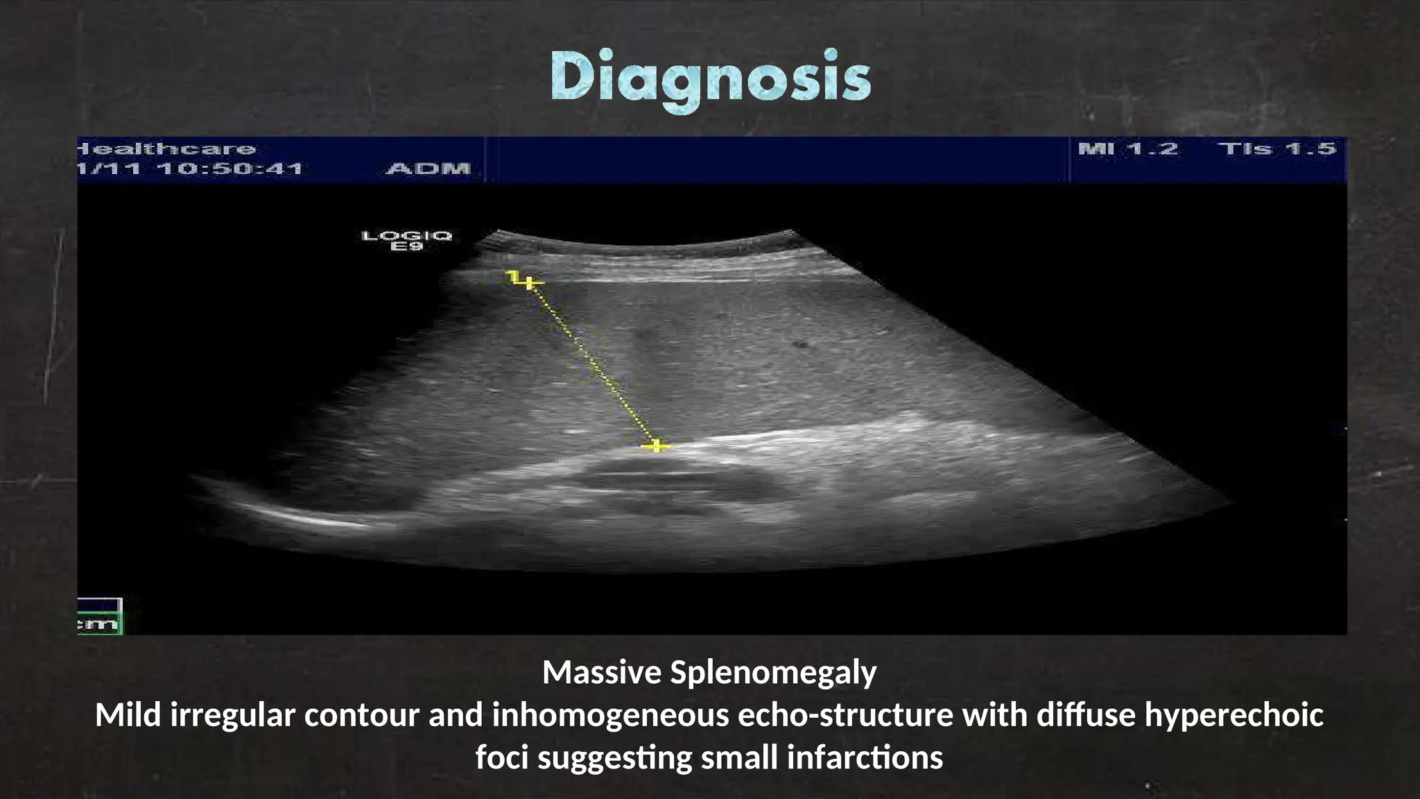 splenomegaly radiology -180319023541.ppt