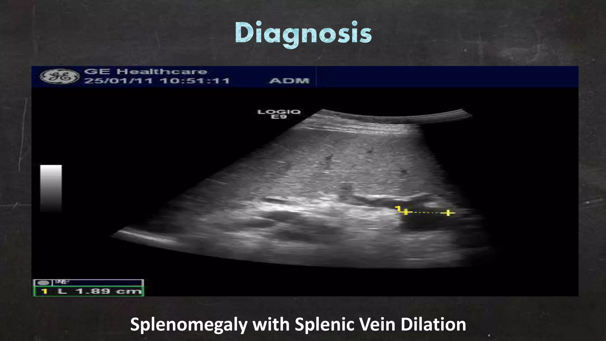 Splenomegaly | PPTX