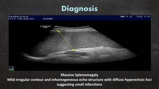 Splenomegaly | PPTX