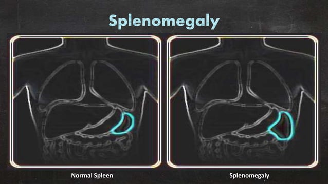 Splenomegaly | PPTX | Digestive Disorders | Diseases and Conditions