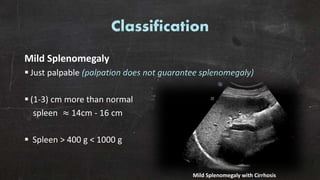 Splenomegaly | PPTX