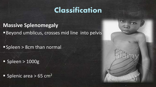 Splenomegaly | PPTX | Digestive Disorders | Diseases and Conditions