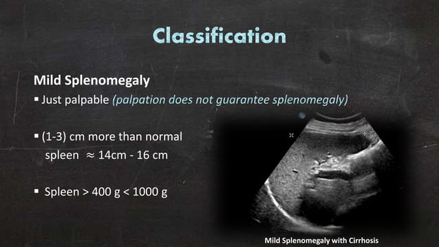 Splenomegaly