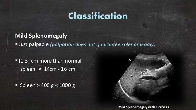 Splenomegaly