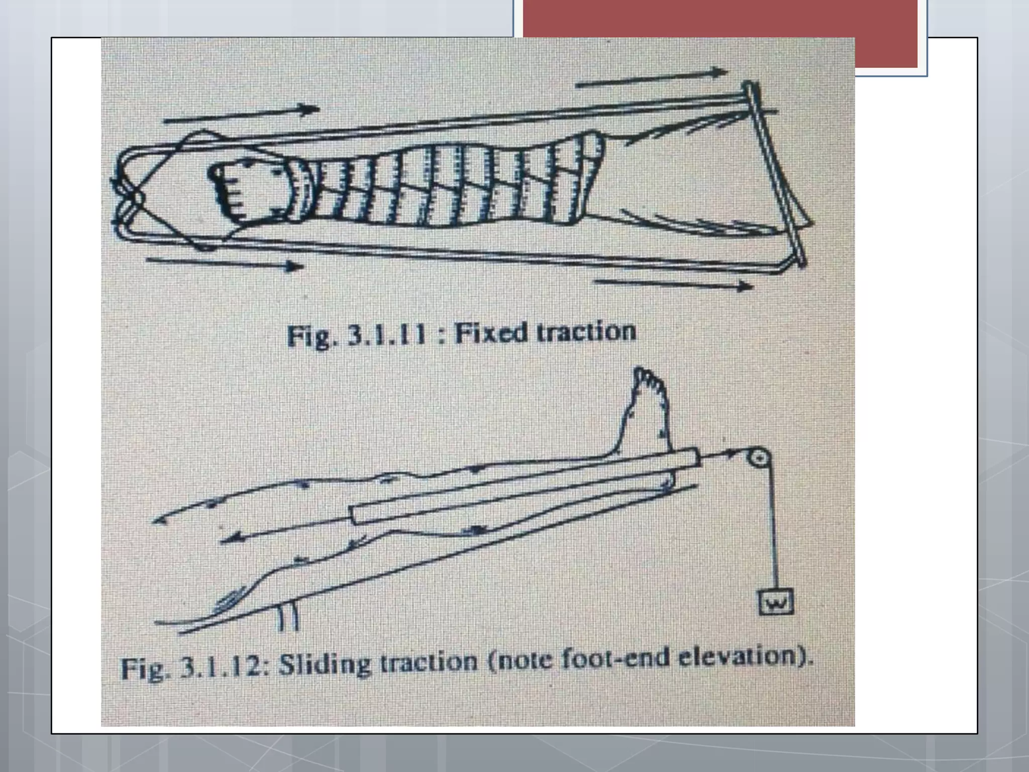 splint-130818021838-phpapp01.pdf