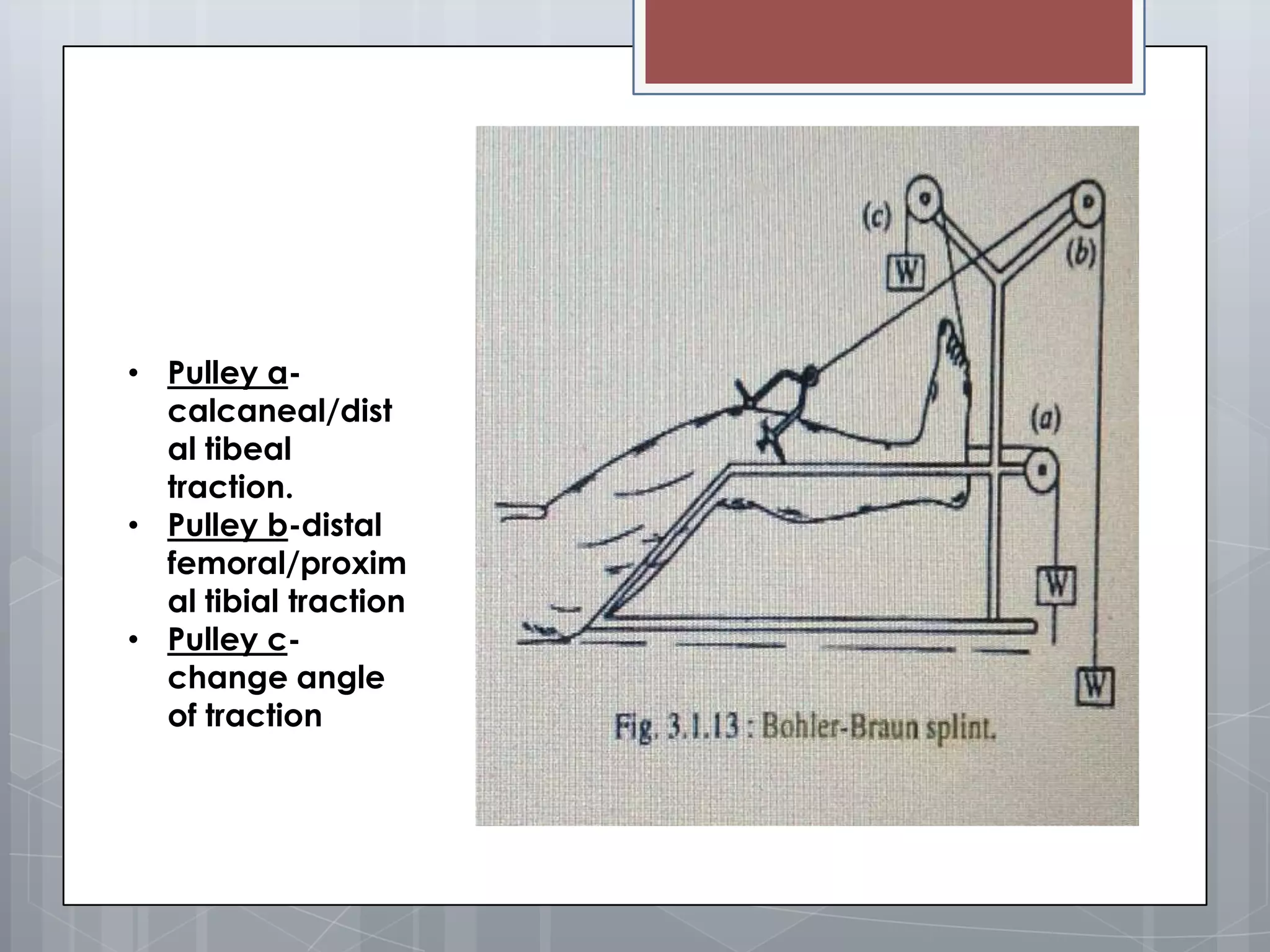 Splint and tractions | PPTX