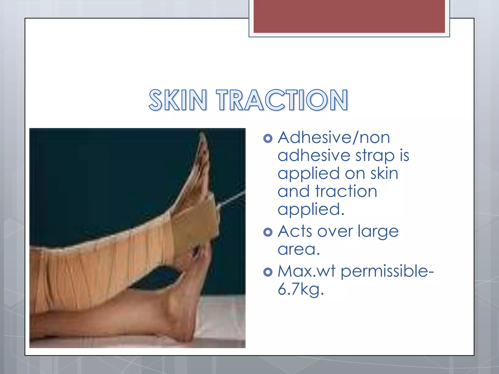 Splint and tractions | PPTX