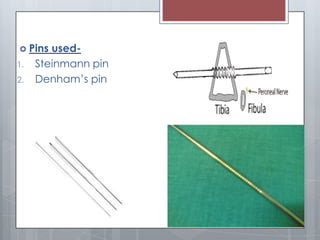 Splint and tractions | PPTX