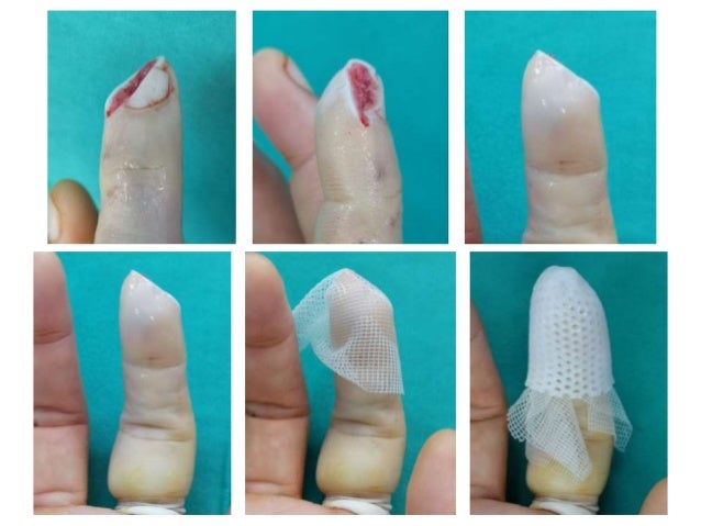 Finger tip injuries