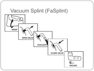 Splinting | PPTX