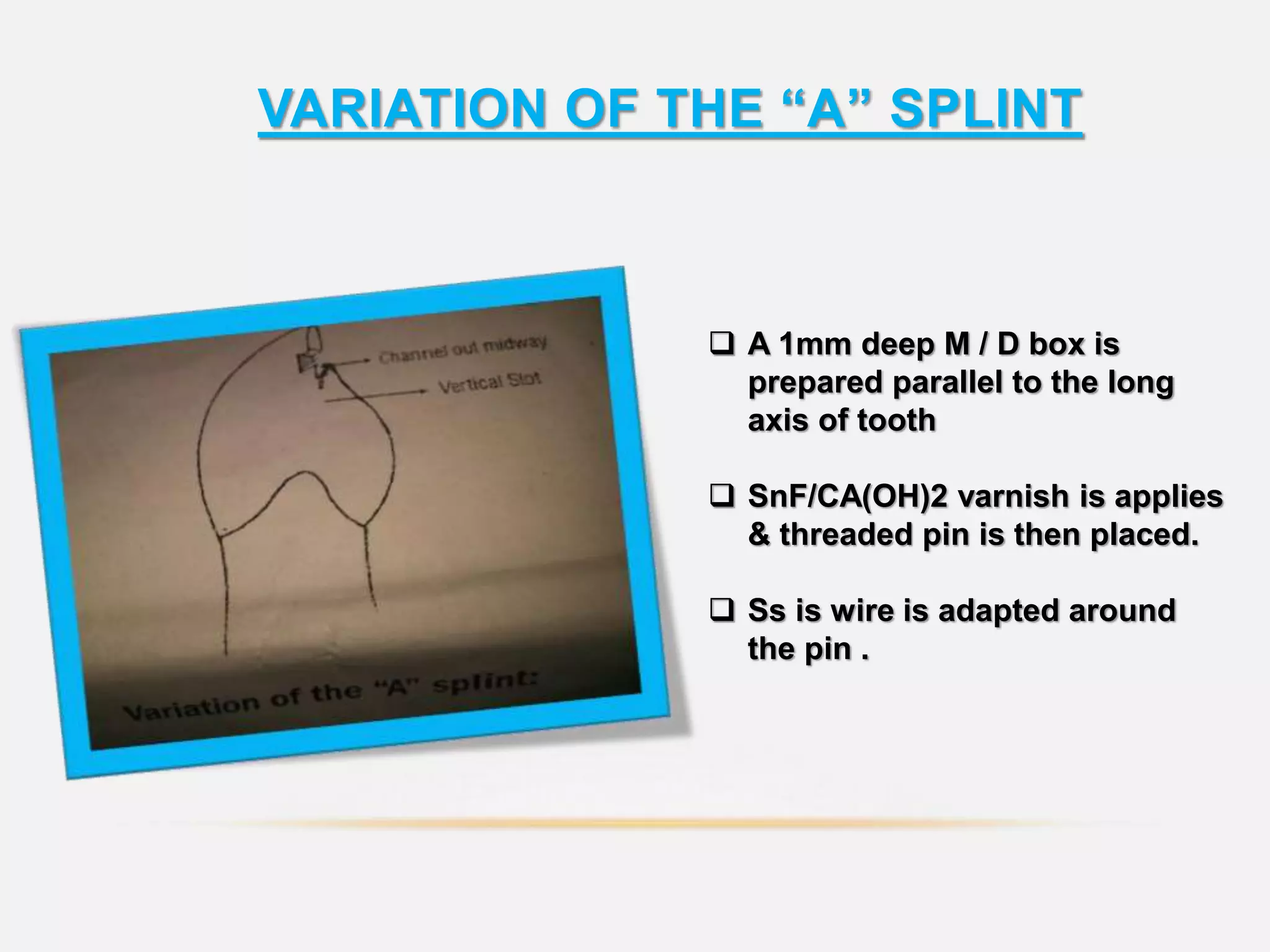 Splinting of teeth in periodontics | PPTX
