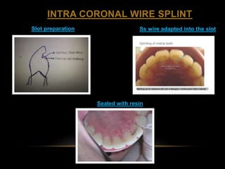 Splinting of teeth in periodontics | PPTX