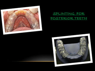 Splinting of teeth in periodontics | PPTX