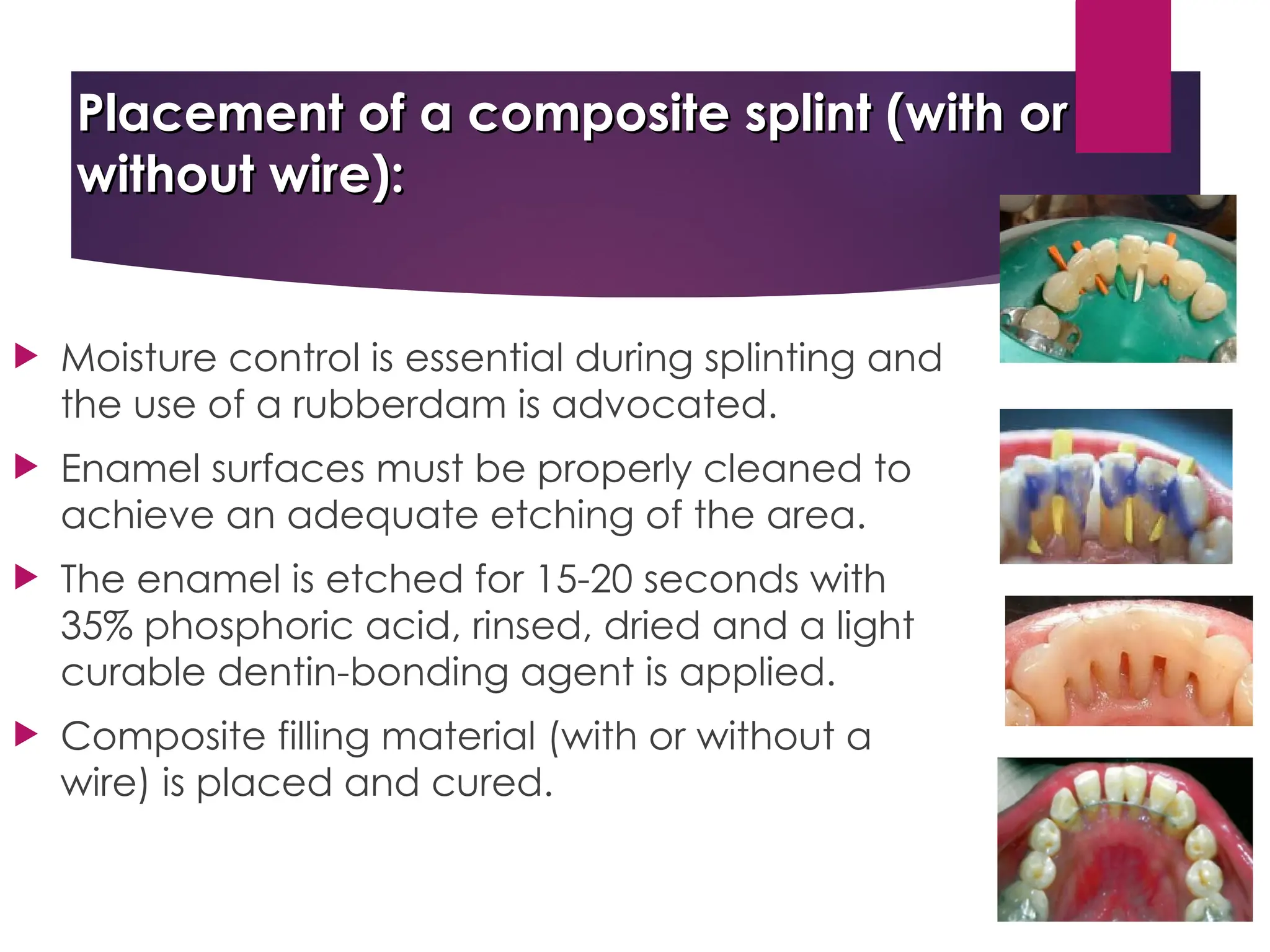 Splinting procedure and steps in dentistry. | PPT