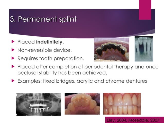 Splinting procedure and steps in dentistry. | PPT | Dental Health ...
