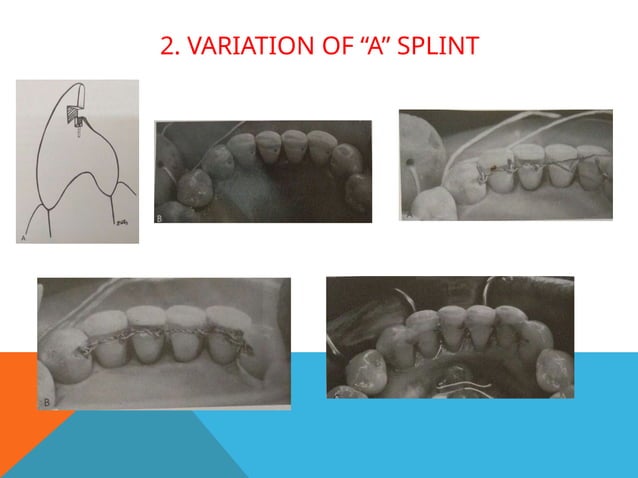Splinting of teeth in human oral cavity. | PPTX