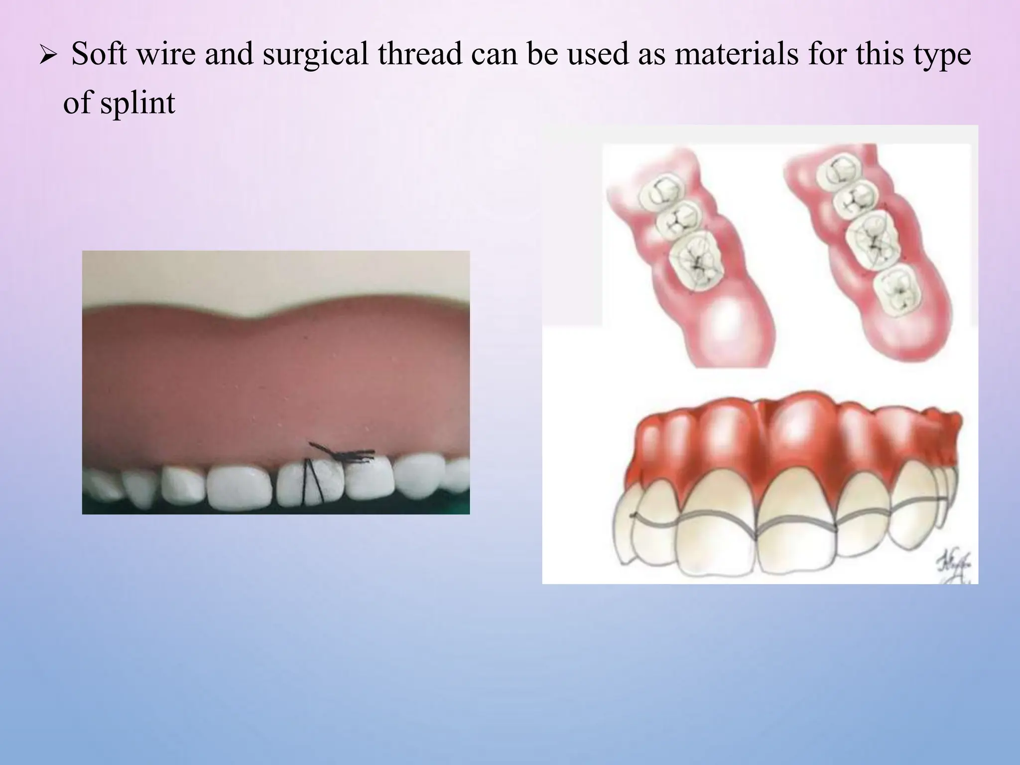 SPLINTING-MATERIALS AND TECHNIQUES final.pptx