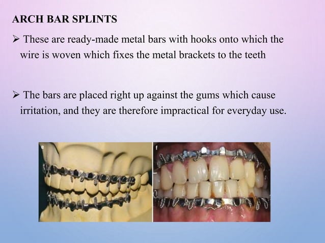 SPLINTING-MATERIALS AND TECHNIQUES final.pptx