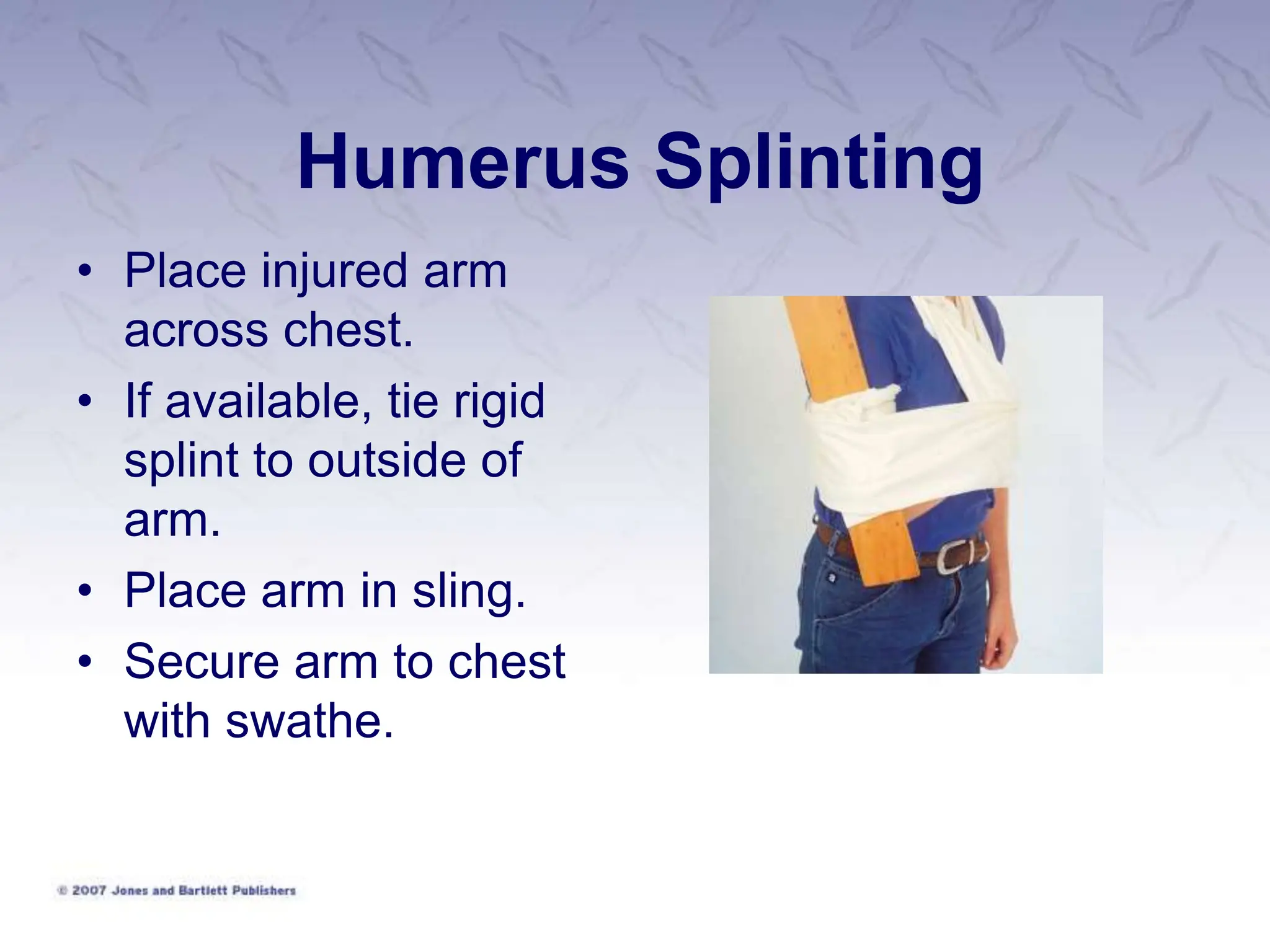 Splinting #6.ppt