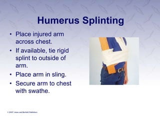 Splinting #6.ppt | First Aid | Injuries