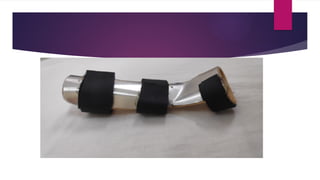 SPLINTING by Dk.pptx.................... | PPTX