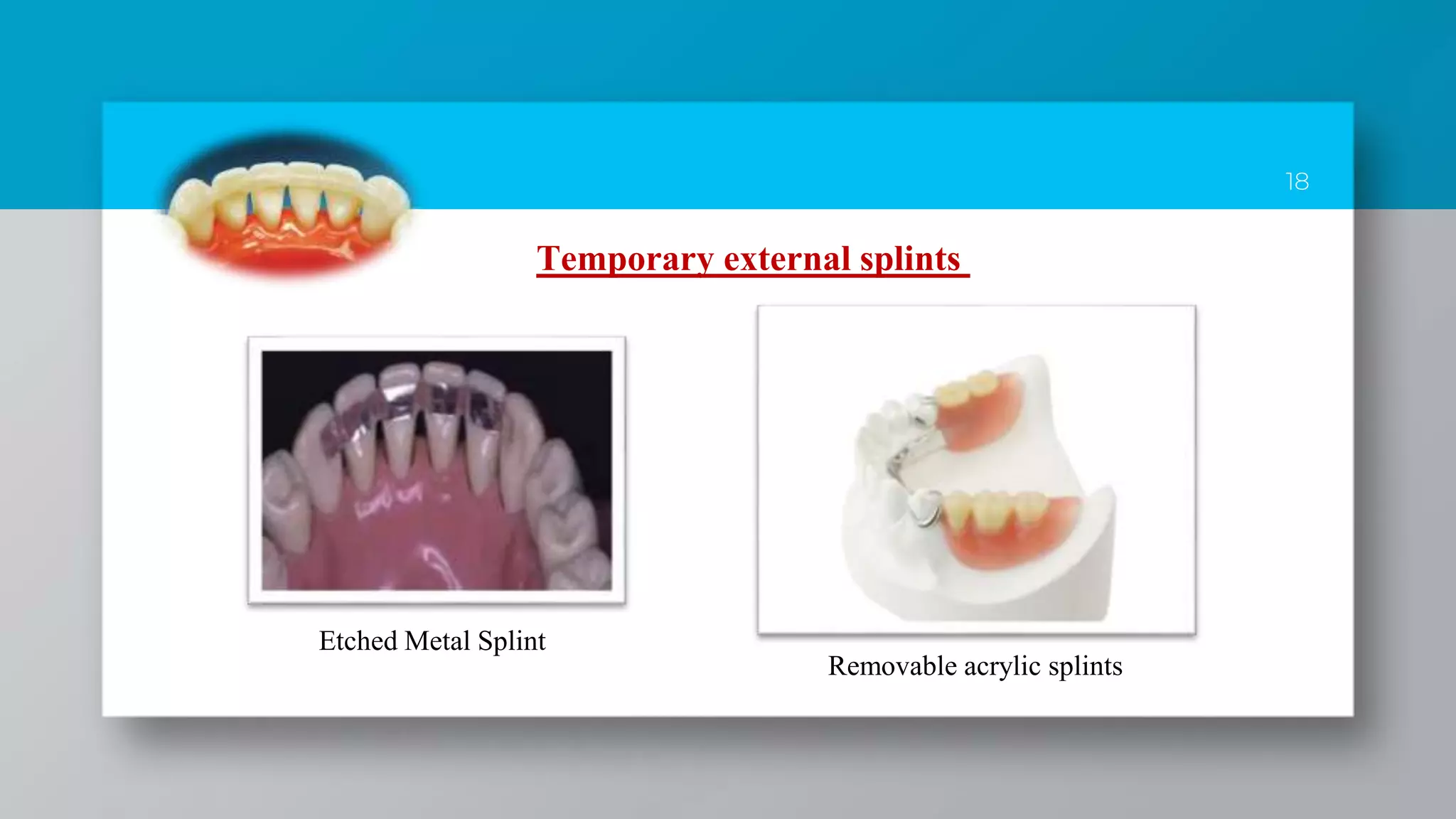 Splinting | PPTX