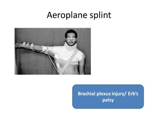 SPLINTING IN ORTHOPAEDICS.explains about various spilint | PPT