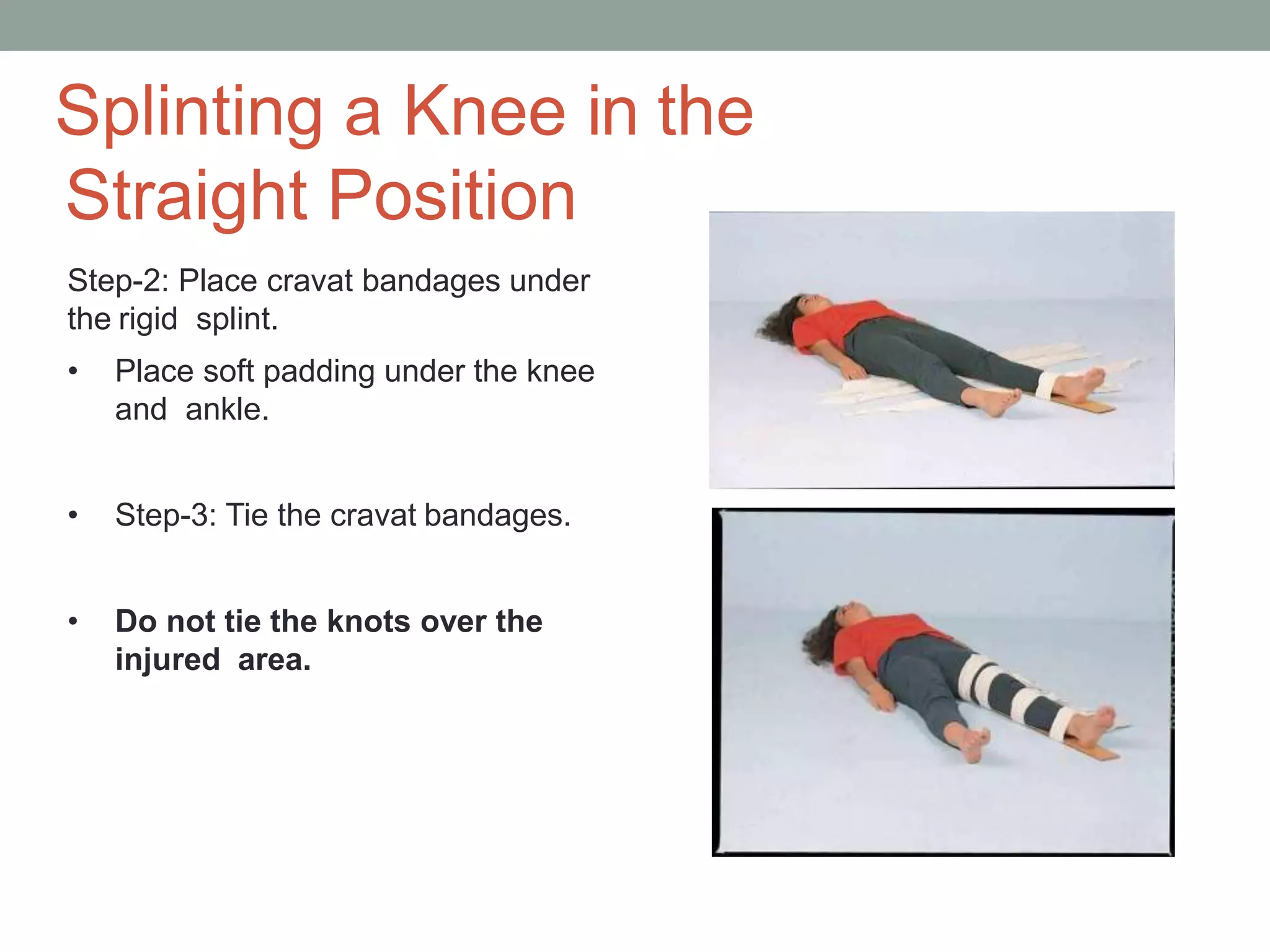 Splinting in sports | PPTX