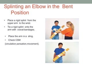 Splinting in sports | PPTX