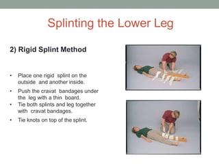 Splinting in sports | PPTX