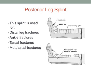 Splinting in sports | PPT