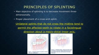 Splinting in Periodontics | PPTX