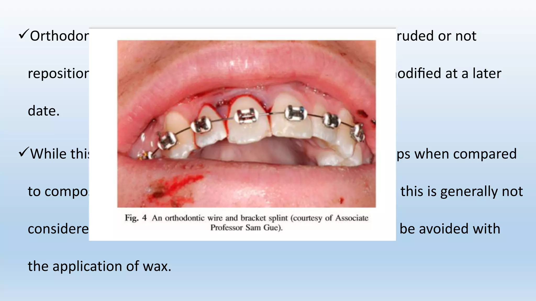 Splinting of traumatized teeth | PPTX