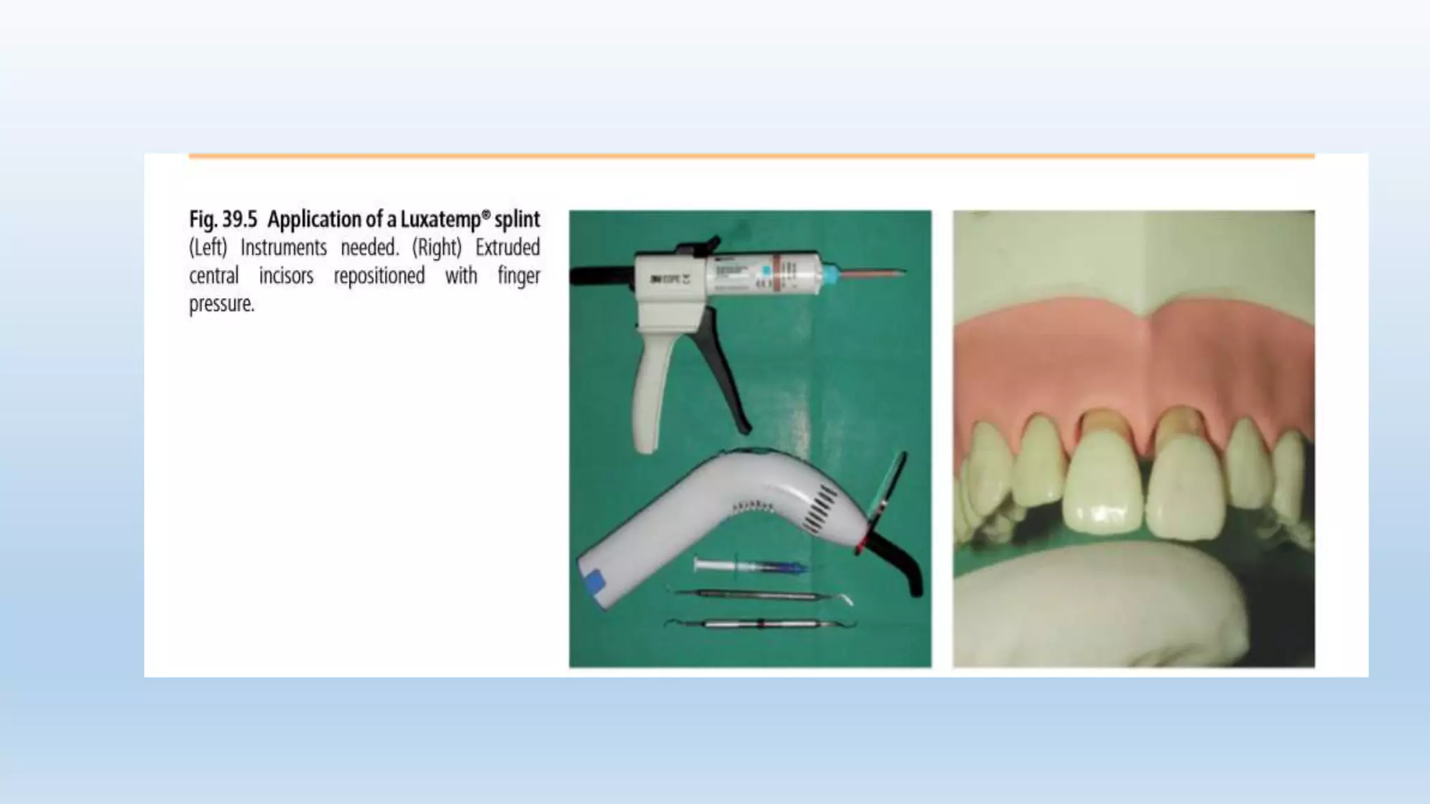 Splinting of traumatized teeth | PPTX