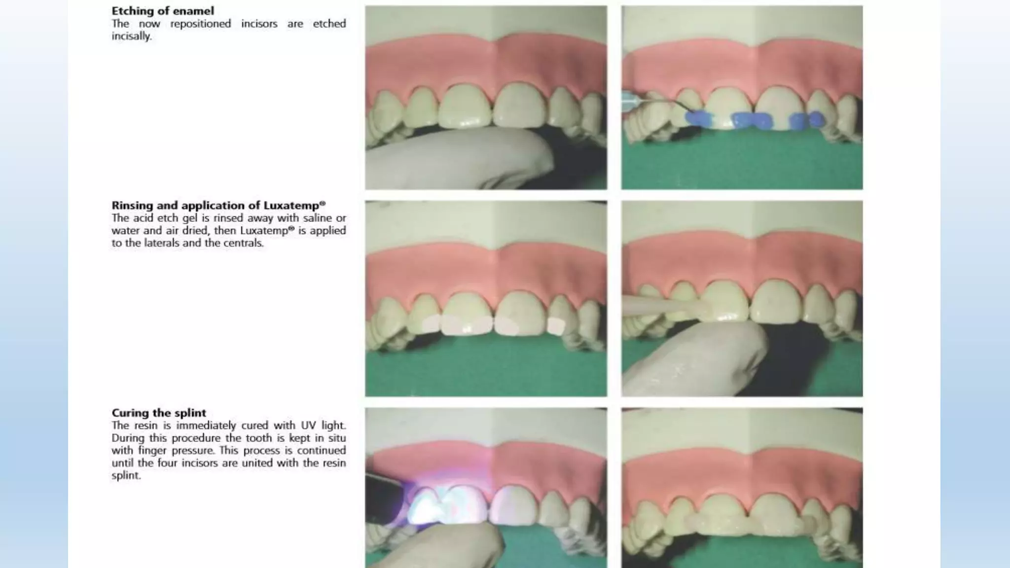 Splinting of traumatized teeth | PPTX